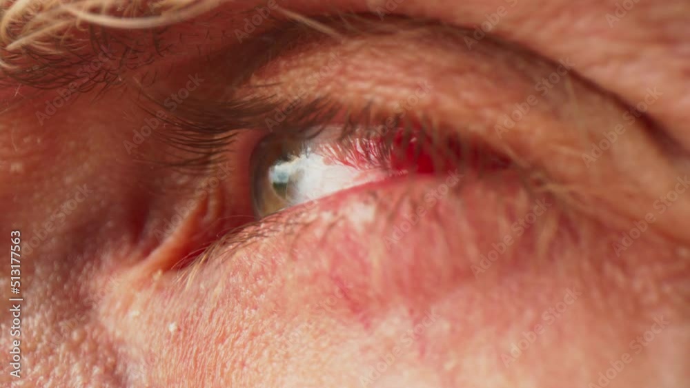 Subconjunctival hemorrhage - hyposphagma. Eye with ruptured blood ...