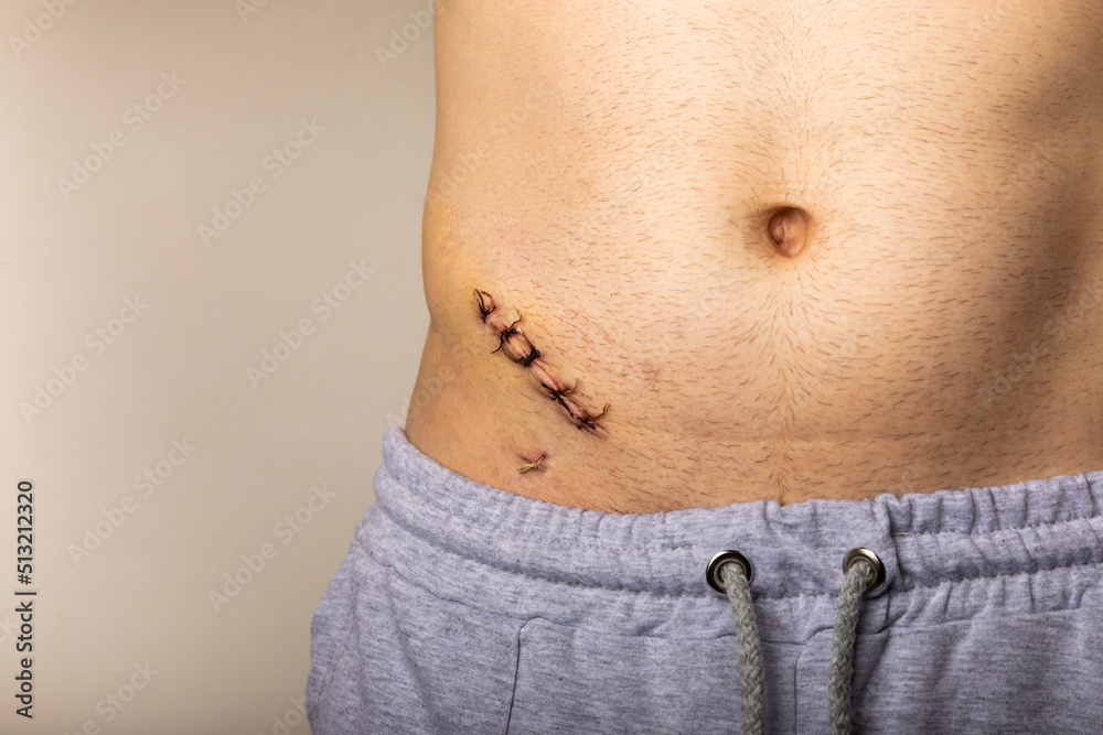 A man shows an appendicitis scar on his stomach, a scar from an ...