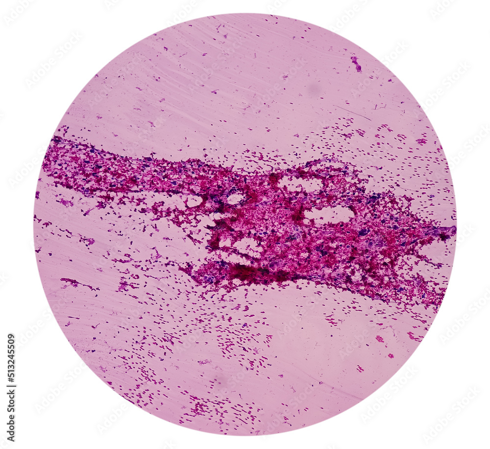 Metastatic Squamous cell carcinoma, Cholangiocarcinoma, adenocarcinoma ...