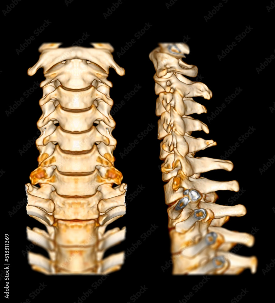 CT SCAN of Cervical Spine ( C-spine ) patient trauma case 3D rendering ...