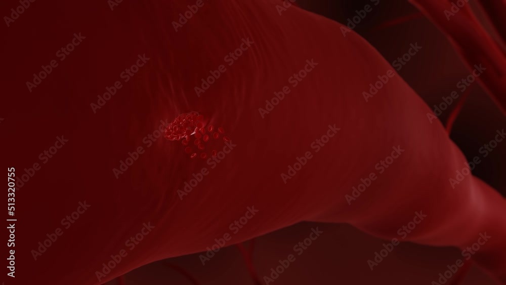 Hemorrhage also known as Internal Bleeding can lead to hemorrhagic ...