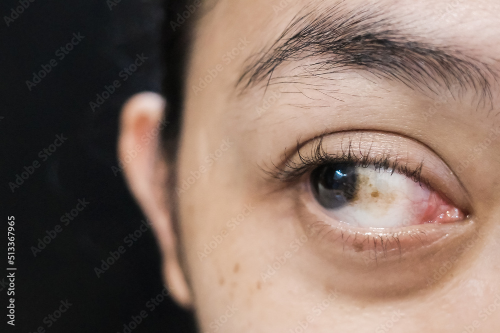 A Woman with Brown Spot on her Sclera Diagnosed as Hemorrhagic ...