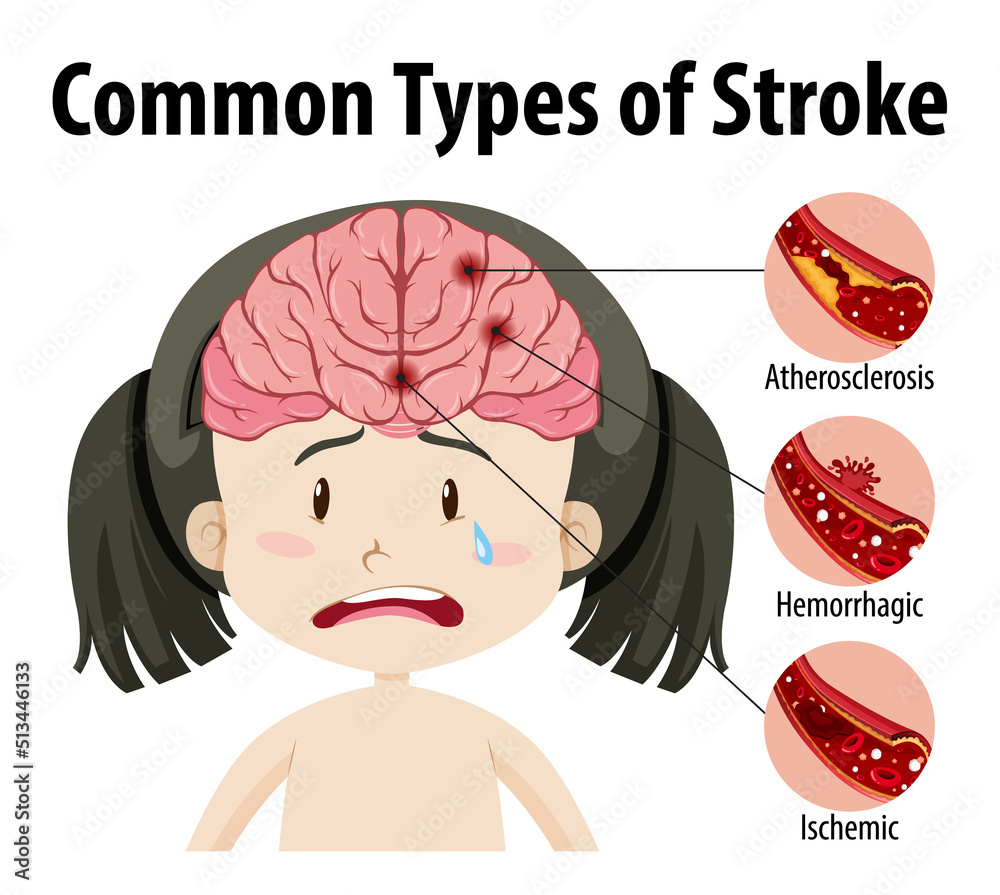 Human with common types of stroke Stock Vector | Adobe Stock