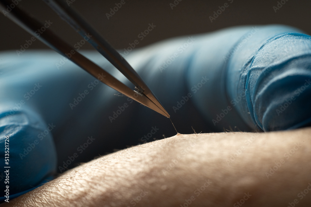 Doctor hair removal specialist, professional electro epilation hair ...