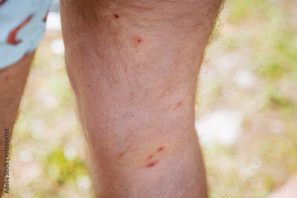 The leg in red dots insect bites, reddening of the skin after midges ...