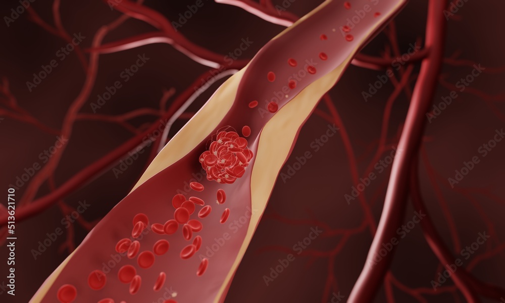 Blood clot, Blocked blood vessel in artherosclerosis (occlusion) Stock ...