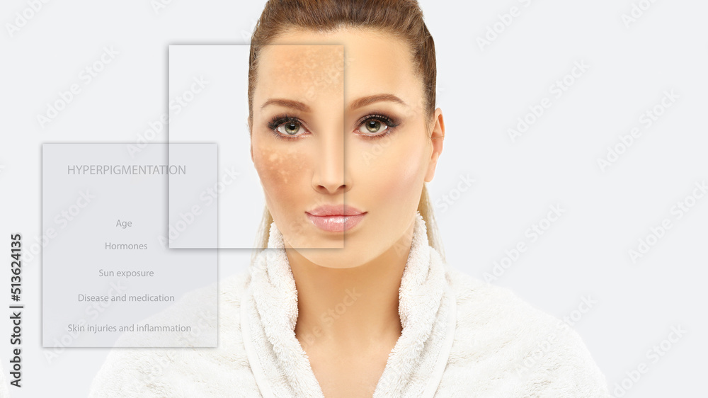Hyperpigmentation: chloasma, melasma , age spots,Post-inflammatory ...
