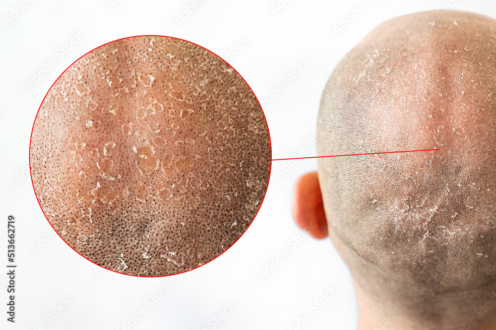 Male bald flaky head with dandruff close-up, back view. White ...