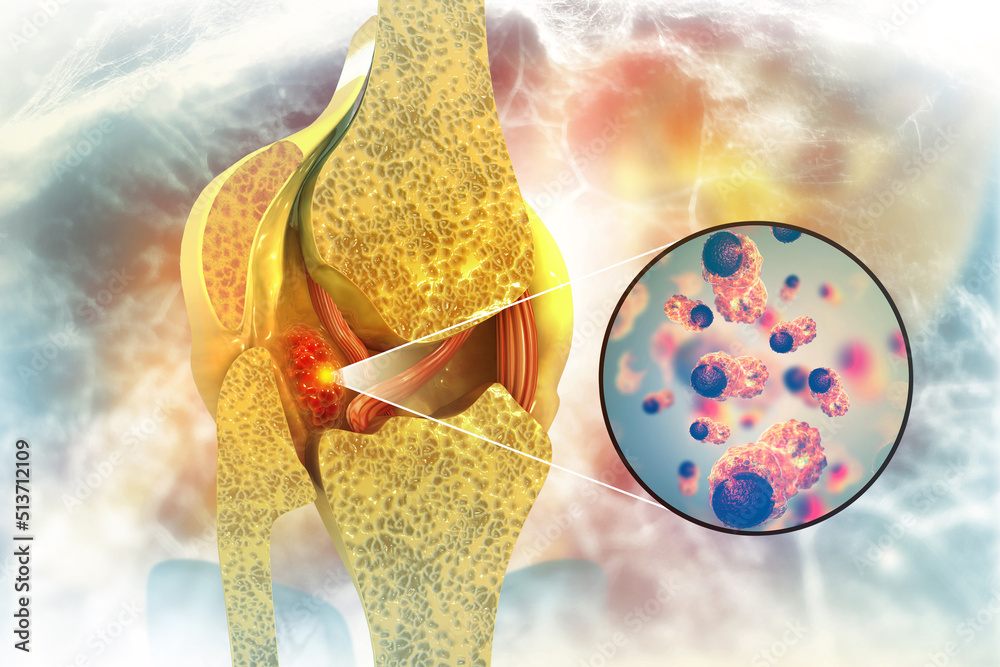 Bone cancer, knee joint, giant cell tumor of bone, osteosarcoma, 3d ...