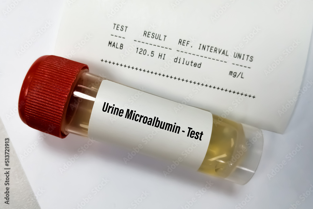 Urine Sample for Urine Microalbumin test. Chronic kidney disease (CKD ...