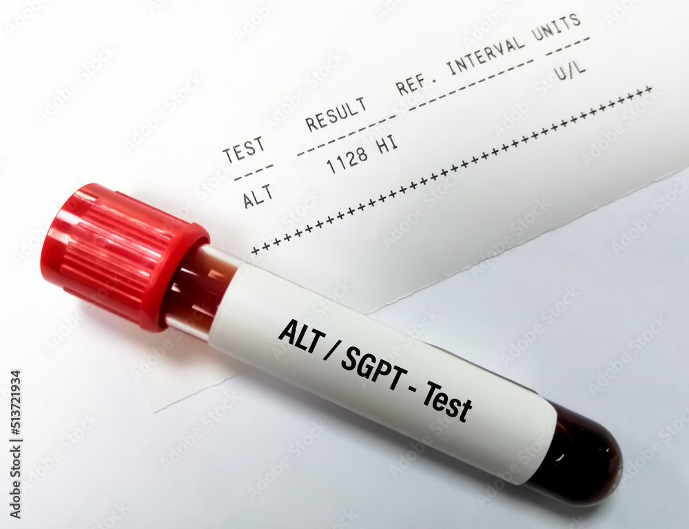 Blood sample isolated for ALT test for the diagnosis of Liver function ...