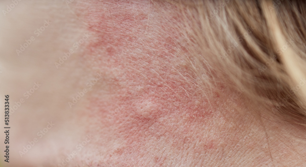 Bite Marks On Human Flesh