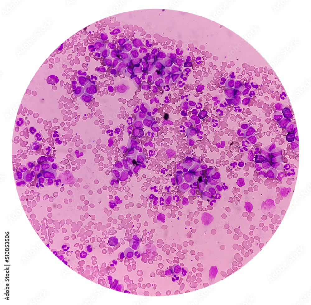 Microscopic image showing Chronic myeloid leukaemia (CML) is a type of ...