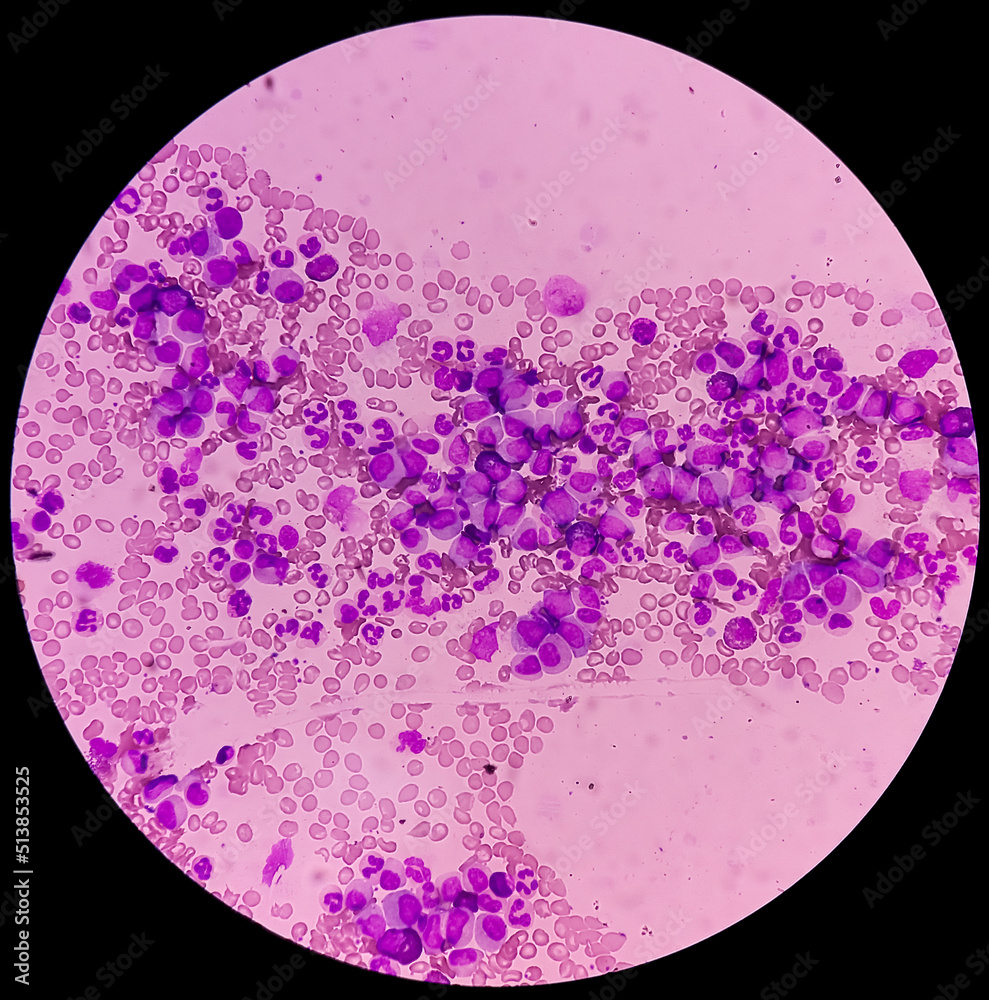 Microscopic image showing Chronic myeloid leukaemia (CML) is a type of ...