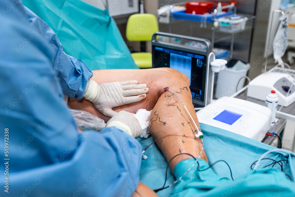 Varicose Veins Surgery Act A Superficial Veins Problems Swollen Skin