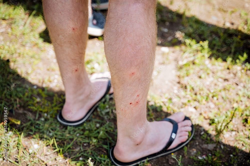 Red dots on human legs, bites of small blood-sucking insects, damage to ...
