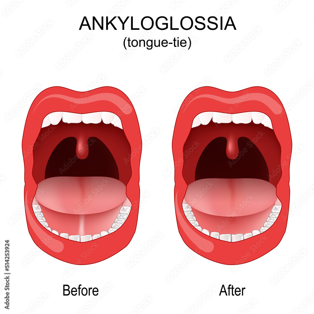 Ankyloglossia Tongue Tie Congenital Oral Anomaly Stock Vector Adobe