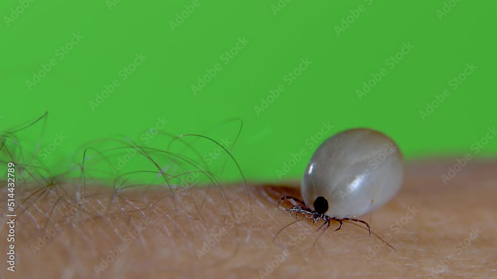 Tick on human skin. Lyme disease and tick-borne encephalitis. Parasites ...