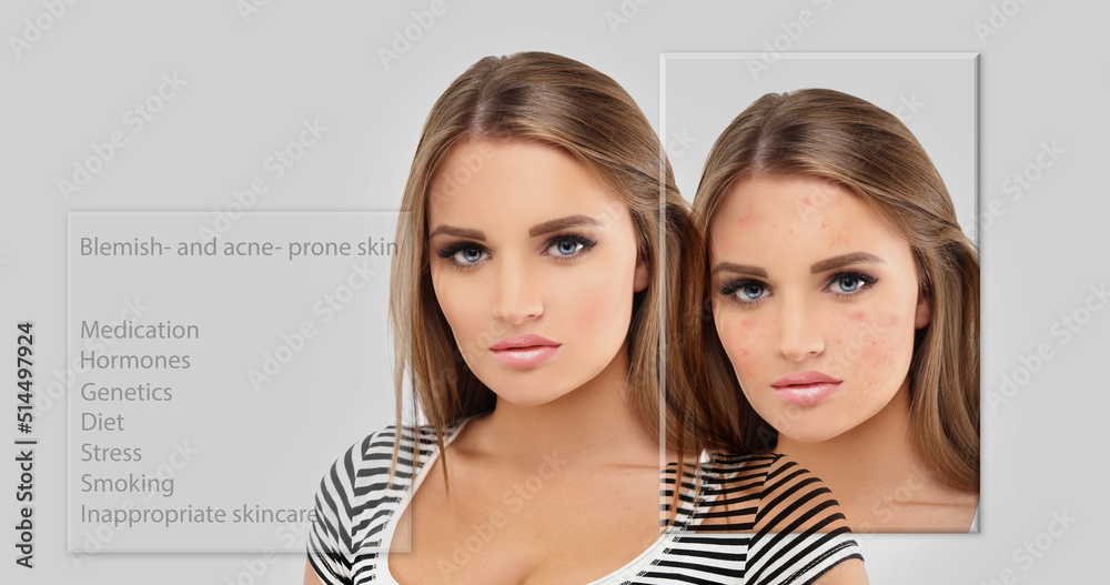 Acne,Skin concern,blemish-prone skin and acne, Rosacea,different types ...