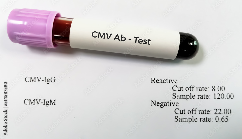 Blood sample tube for cytomegalovirus (CMV) antibody testing with ...