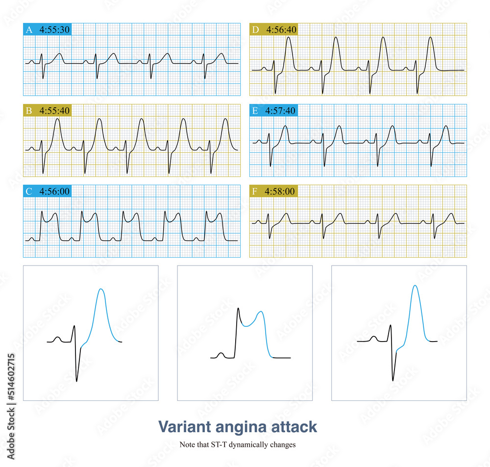 In this case, when the variant angina pectoris attacked, note the loss ...