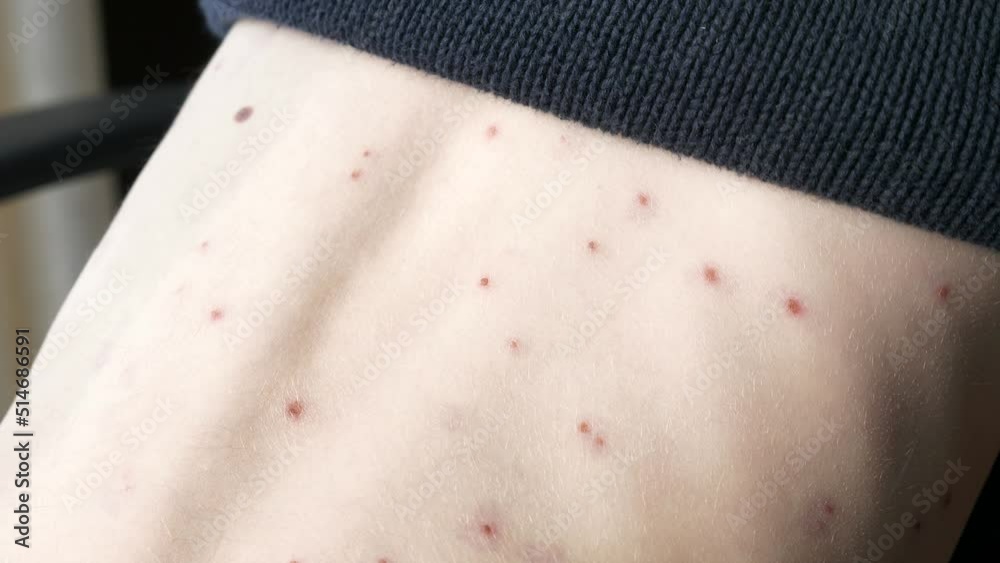 Close-up Kid Back with Rash of Itchy Inflamed Blisters. Chickenpox ...