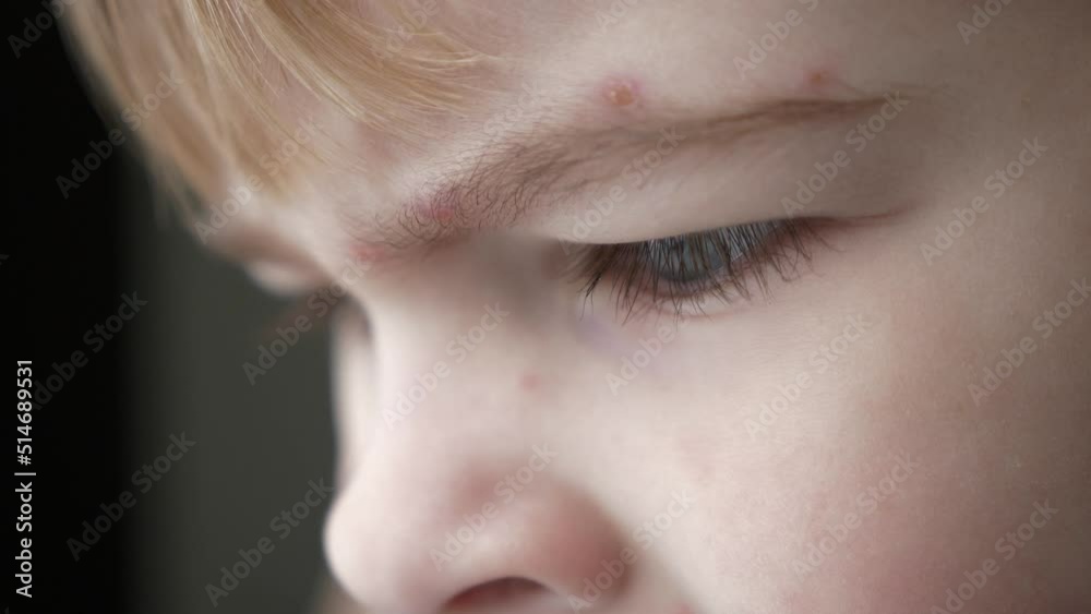Close-up Kid Face Covered with Rash of Itchy Inflamed Blisters ...