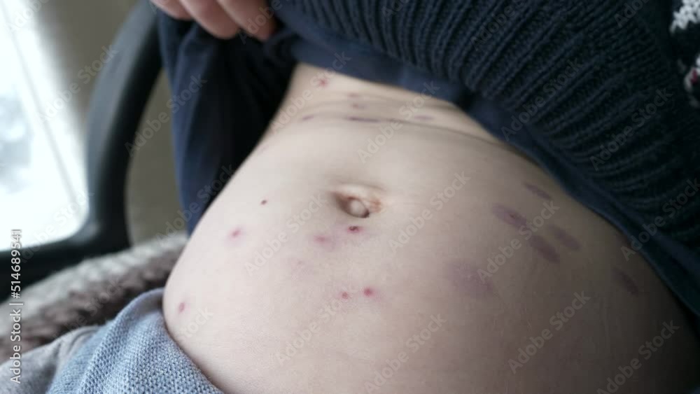 Close-up Kid Belly Chest Body Covered with Rash of Itchy Inflamed ...