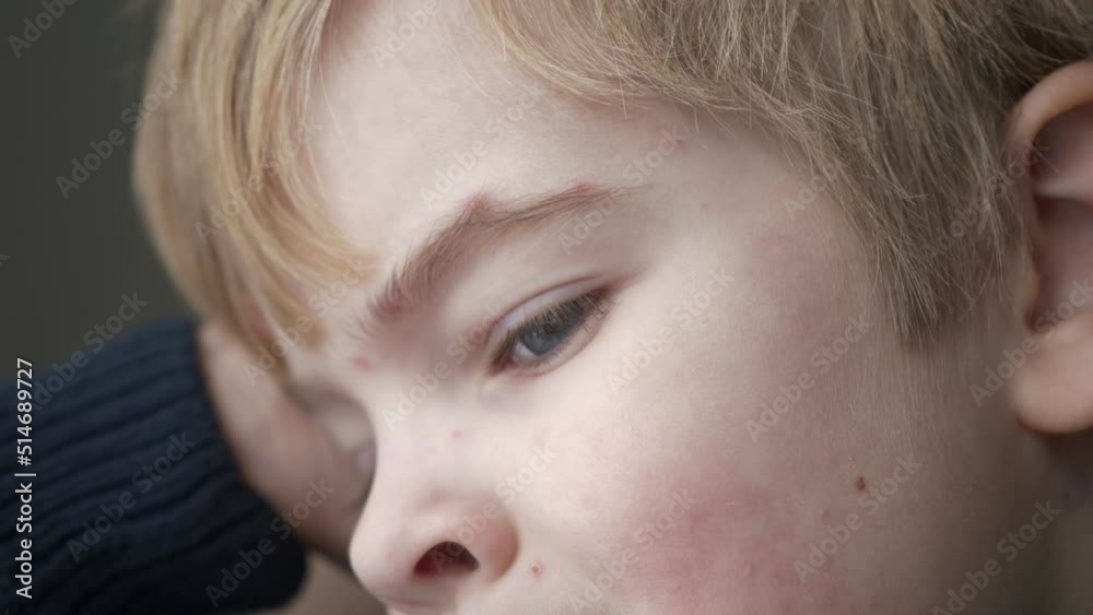 Close-up Kid Face Covered with Rash of Itchy Inflamed Blisters ...