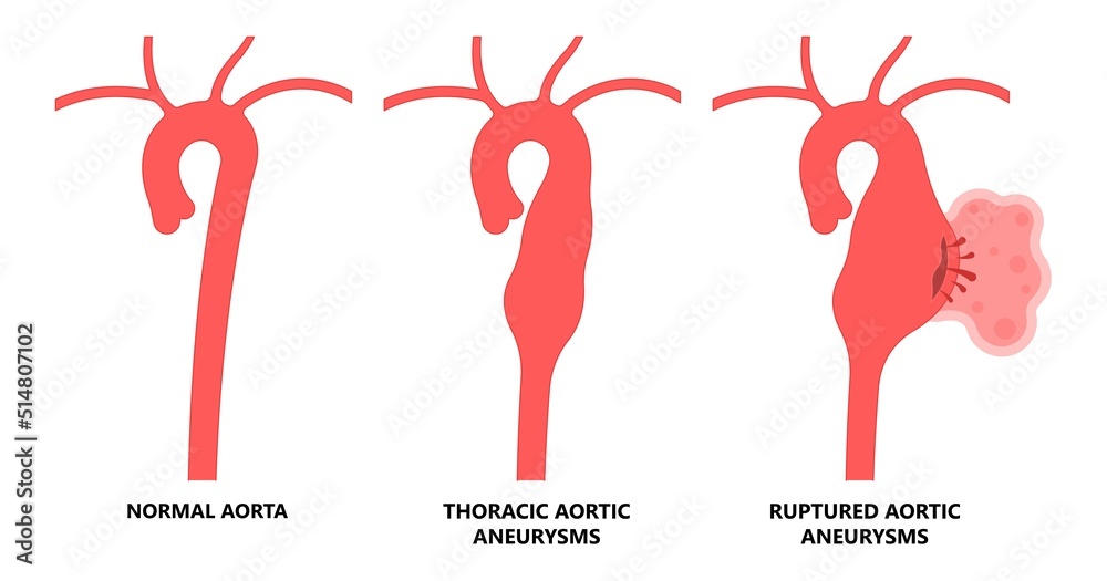 heart blood vessel dilated open with stroke aortic arch stent aorta ...