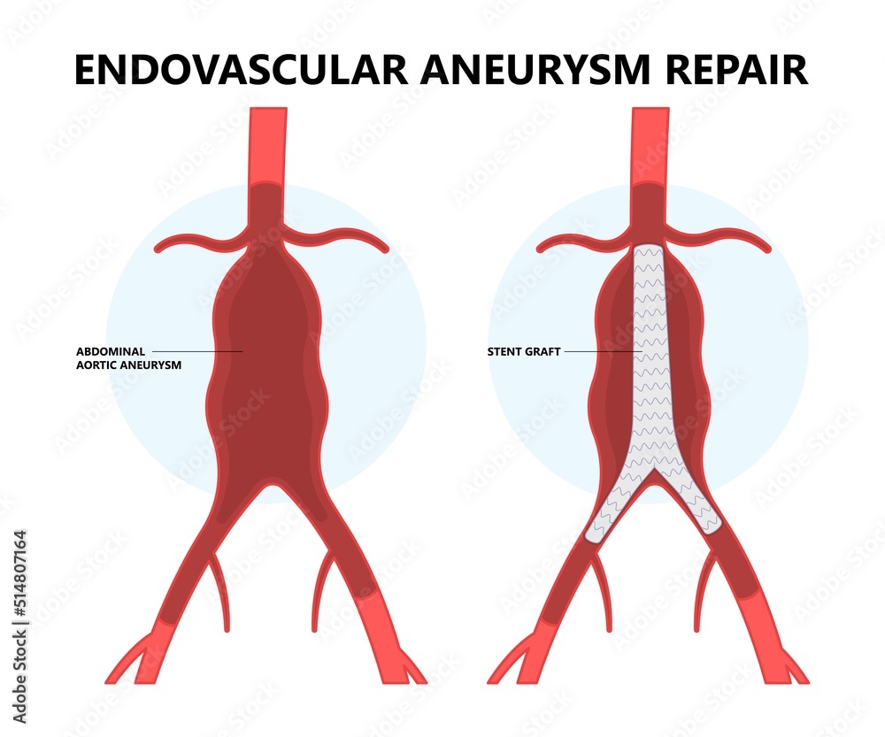 aortic arch pain with hernia blood vessel clots and stent dilated open ...
