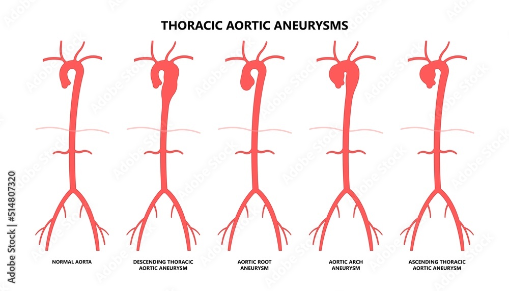 left aorta root bulge heart blood vessel clots aortic arch damage and ...