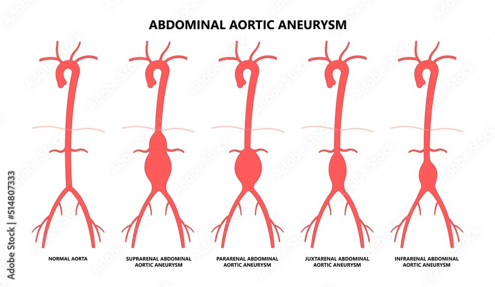 type of heart blood vessel clots left aorta root bulge aortic arch ...