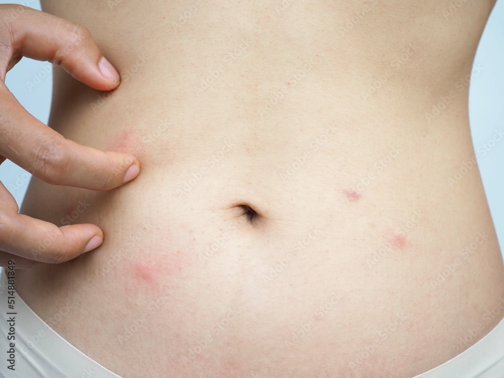 Woman scratching her stomach. caused by hives, insect bites, health ...