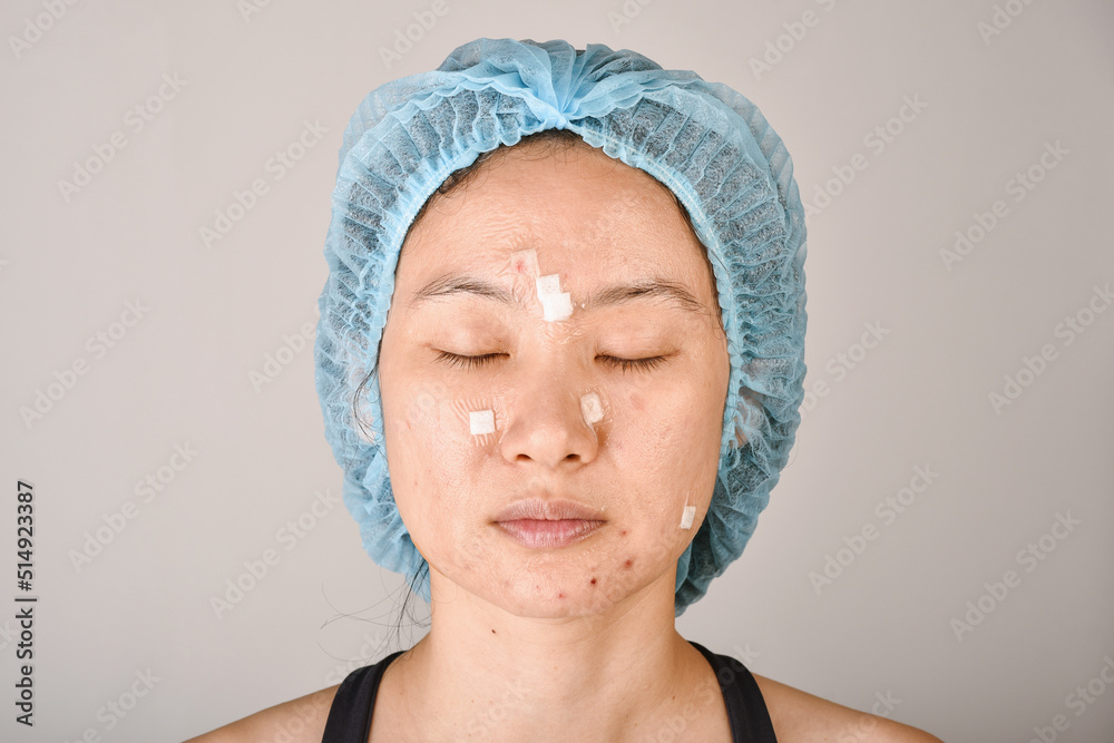 Facial skin problem, Acne disease in adult, Close up woman face with ...