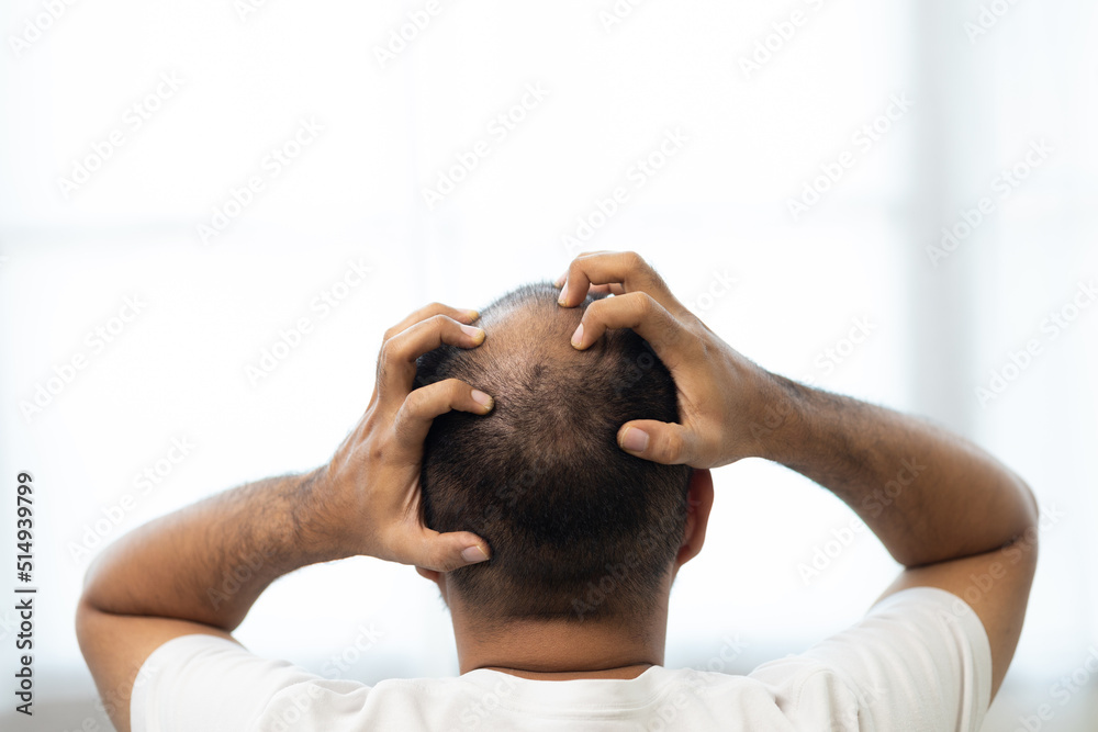 Close up man hair loss. Young man itchy head There is a fungus on the ...