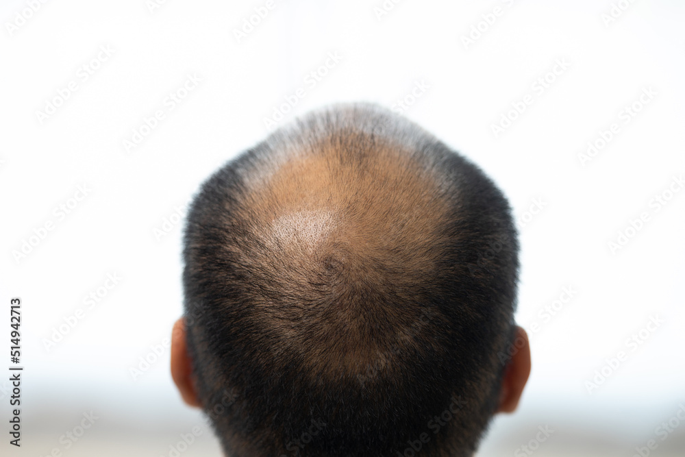 Close up man hair loss. Young man itchy head There is a fungus on the ...