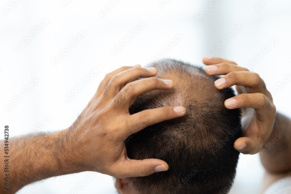 Close up man hair loss. Young man itchy head There is a fungus on the ...