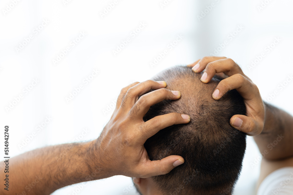 Close up man hair loss. Young man itchy head There is a fungus on the ...