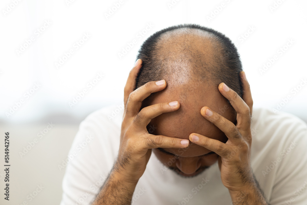 Close up man hair loss. Young man itchy head There is a fungus on the ...
