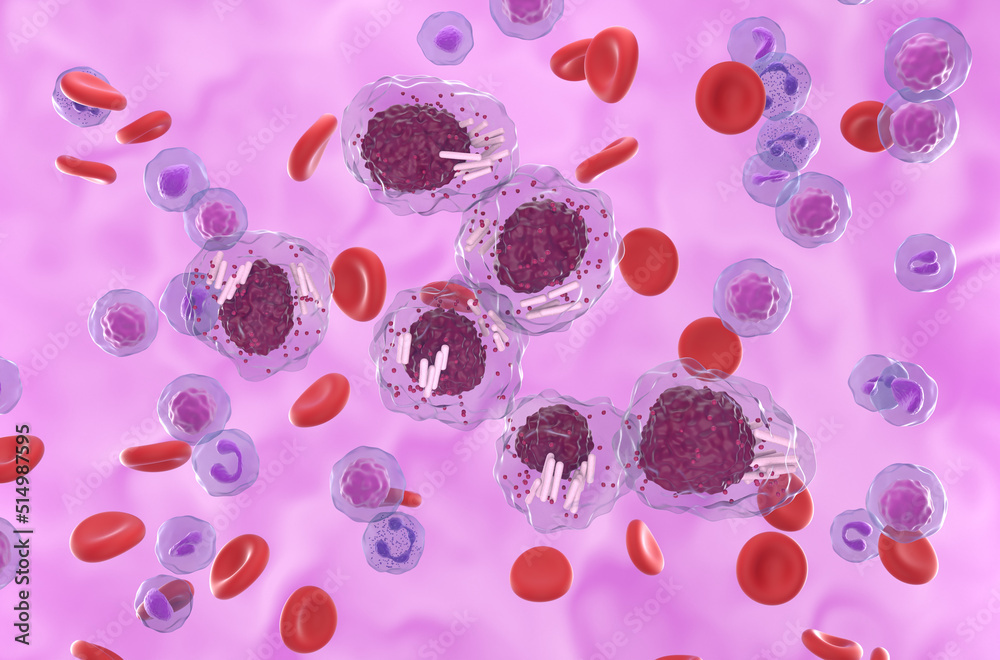 Poster Chronic lymphocytic leukemia (CLL) cells cluster in blood flow ...