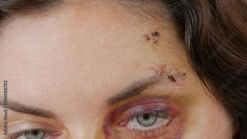 Large real bruise hematoma under the eye of a young woman, purple ...