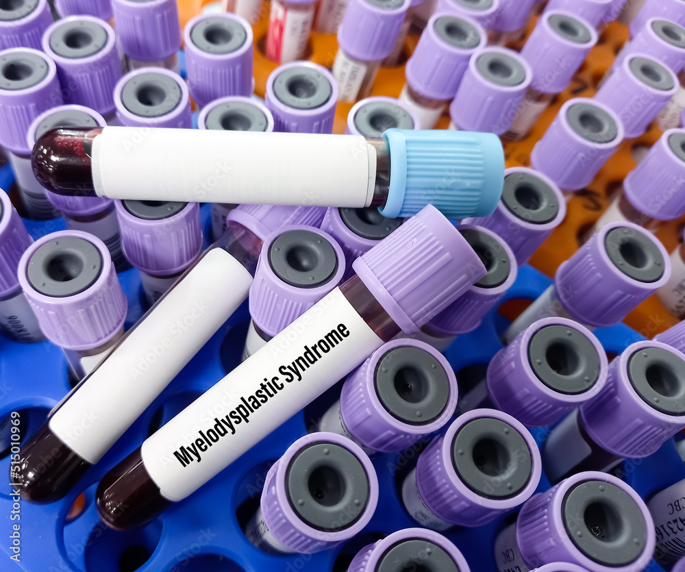 Blood sample for Myelodysplastic syndrome test, close and focus view ...