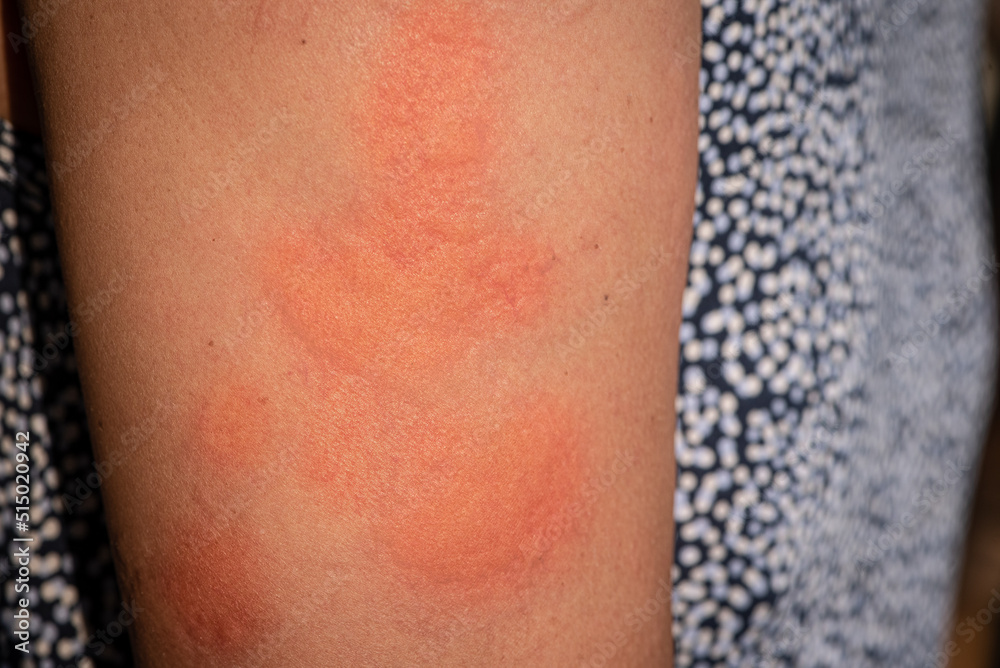 Skin of woman arm suffering severe symptom from urticaria or hives ...