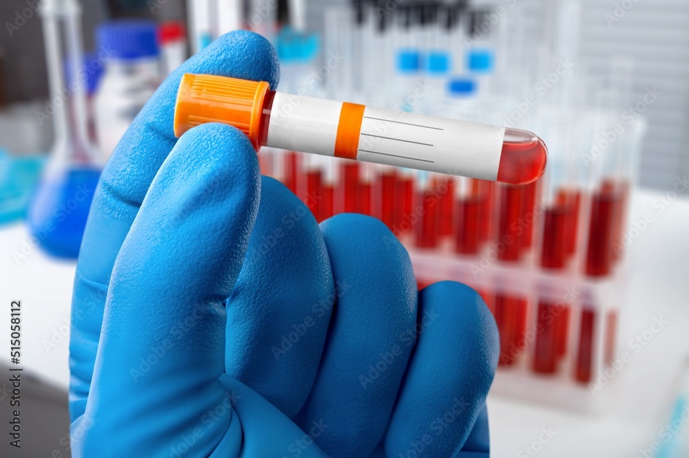 Blood sample of patient for complete screening test in laboratory ...