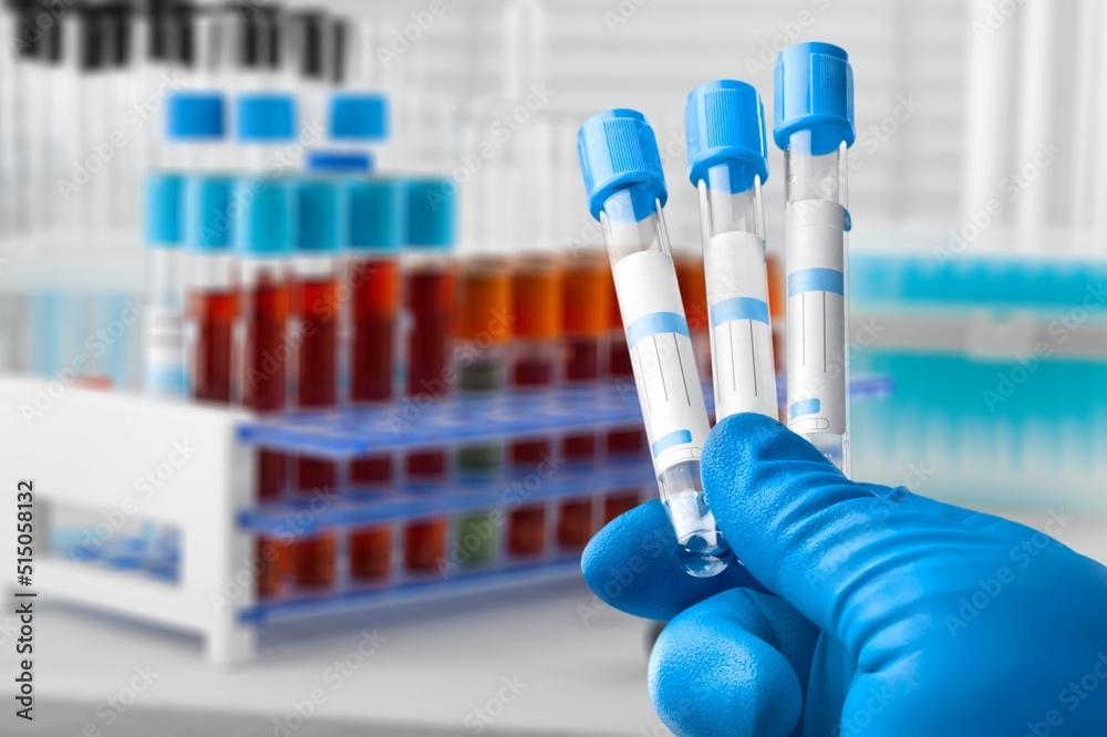 Blood sample of patient for complete screening test in laboratory ...