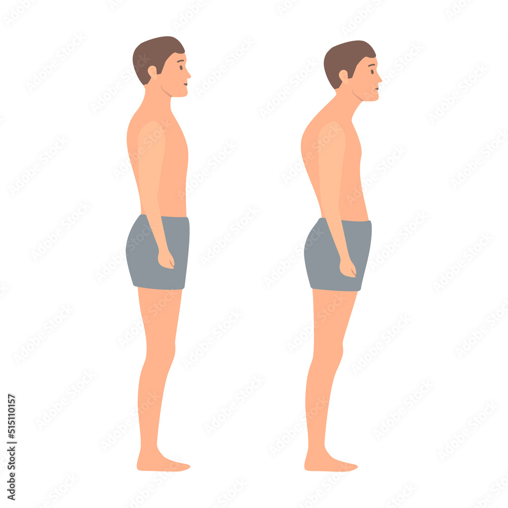 Good and bad posture on male body in side view. Spine curvature with ...