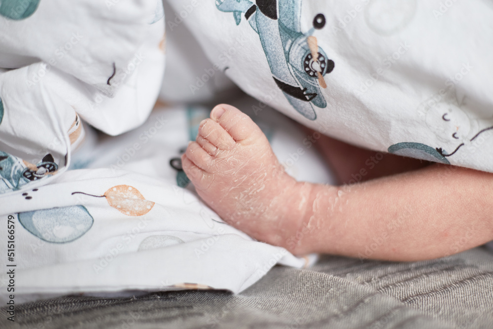 Close up photo of Newborn baby feet with flaky dry skin. Infant after ...