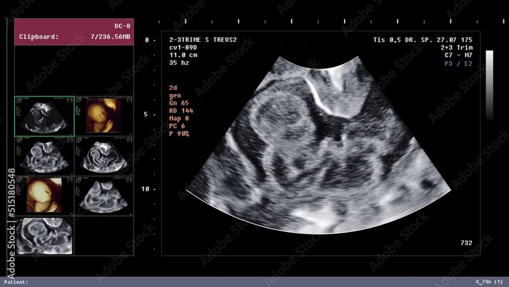 Prenatal Diagnostic Test Of The Fetus Inside Of The Female Womb Using