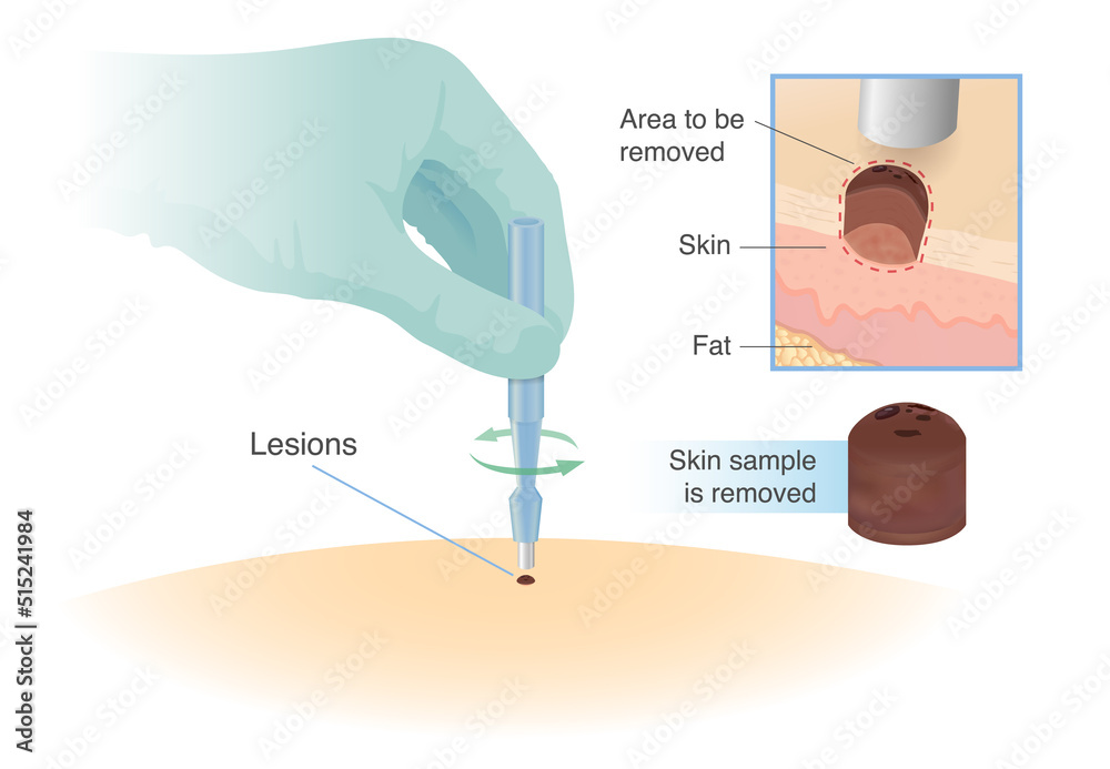 Removed a sample of skin with the Biopsy punches tool. Cut small tissue ...